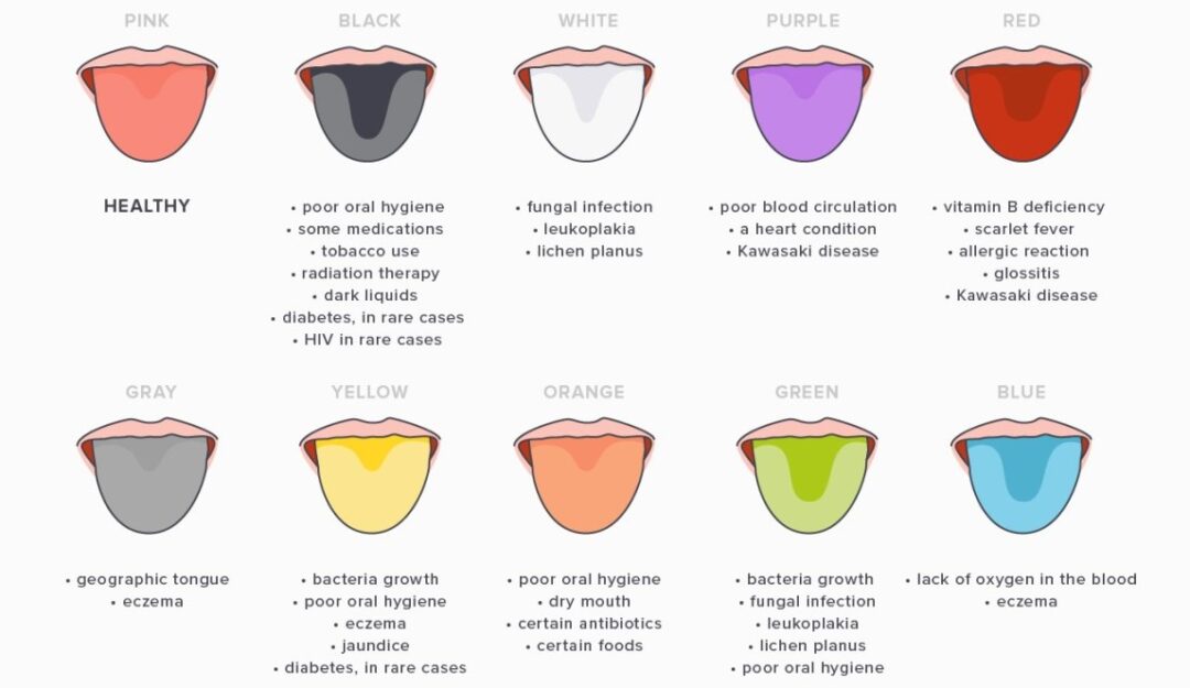 Culoarea normala a limbii-modificari de culoare si forma – Dentisis